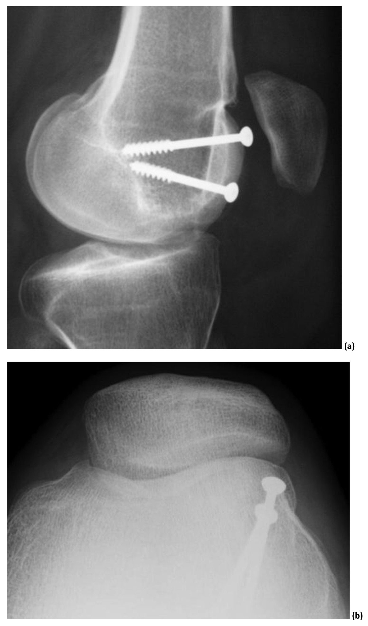 Trochleoplasty in major trochlear dysplasia: current concepts | BMC ...