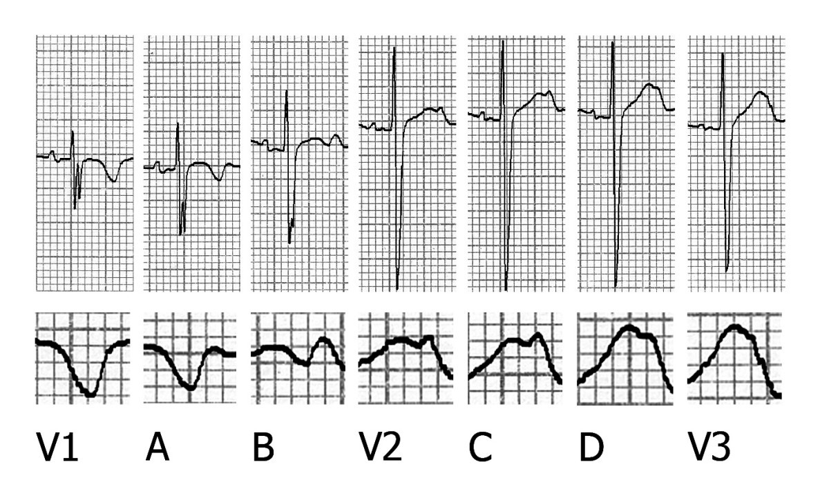Bifid T waves in leads V2 and V3 in children: a normal variant ...