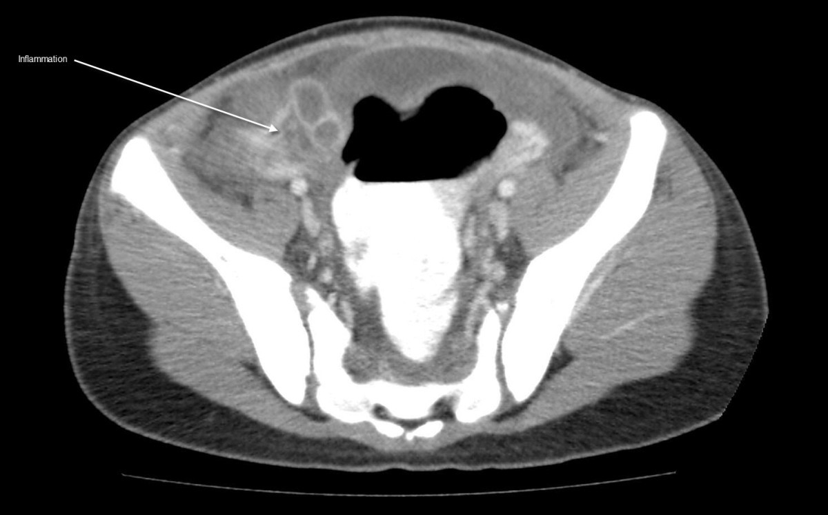 Bilateral pyosalpinx in a peripubescent female with Hirschsprung's ...
