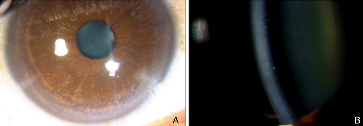 Associations of Fuchs heterochromic iridocyclitis in a South Indian ...
