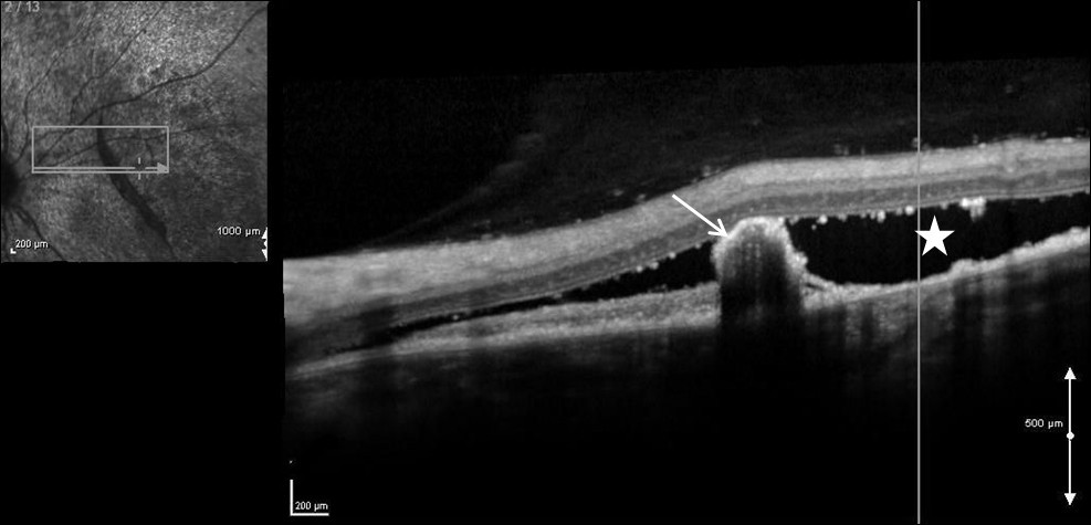 High definition spectral domain optical coherence tomography of retinal ...
