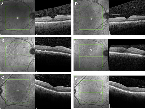 Spectral domain optical coherence tomography findings in acute ...