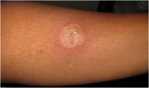 Unilateral snow banking in tuberculosis-related intermediate uveitis ...