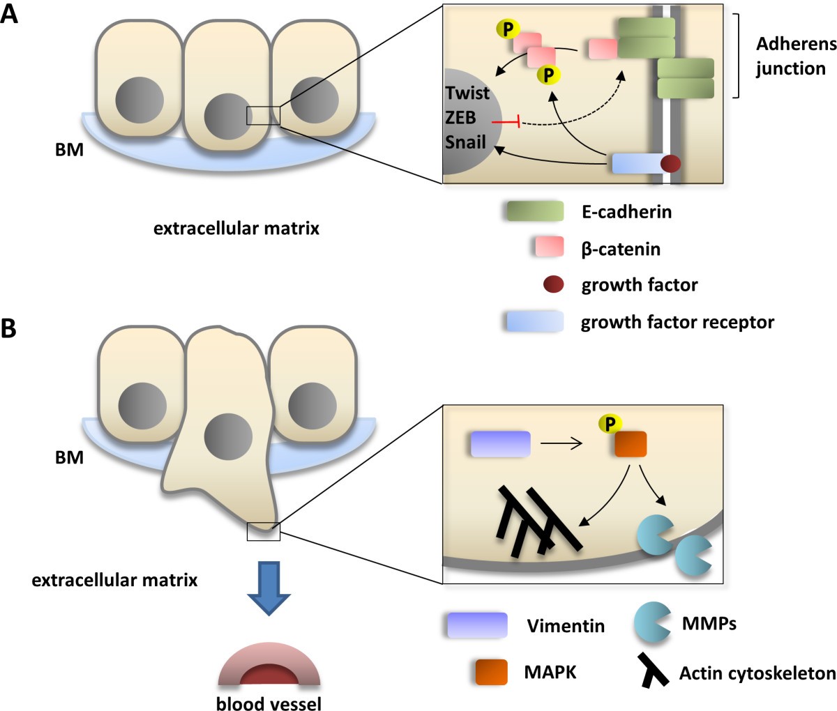 Clinical Significance Of Epithelial Mesenchymal Transition Clinical