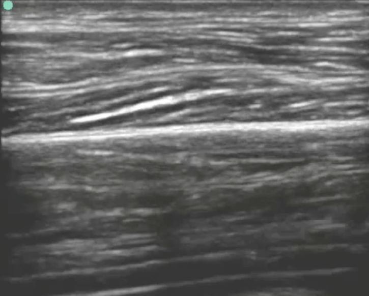 Emergency department diagnosis of a quadriceps intramuscular loculated ...