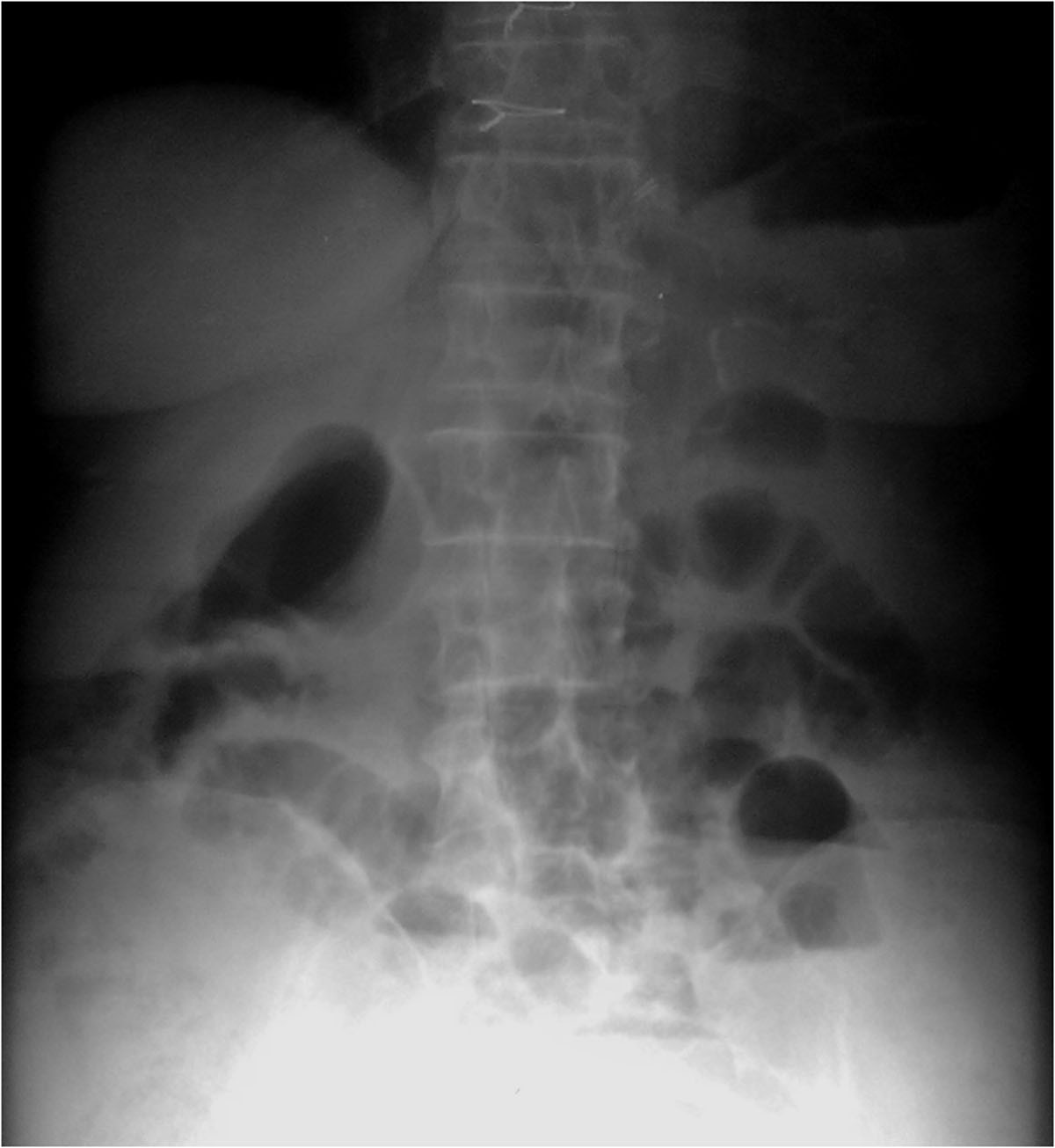 Intestinal Ischemia: US-CT findings correlations | Critical Ultrasound ...