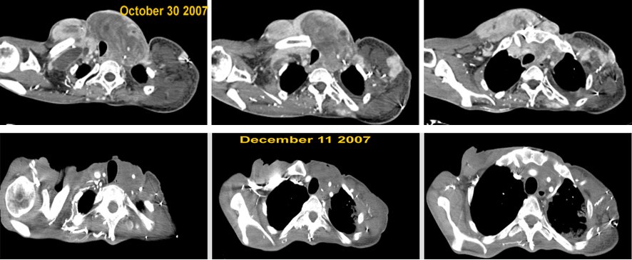 Dermatofibrosarcoma protuberans (DFSP) successfully treated with ...