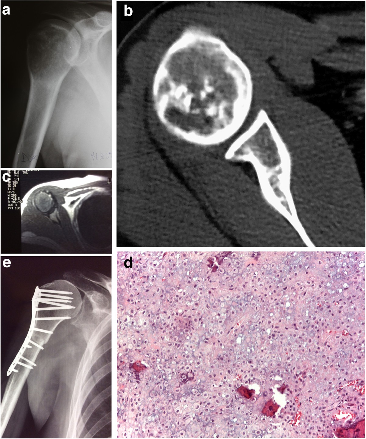 Multiple or metastatic clear cell chondrosarcoma: a case report ...