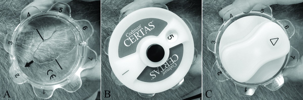 Initial experience with the Codman Certas adjustable valve in the ...