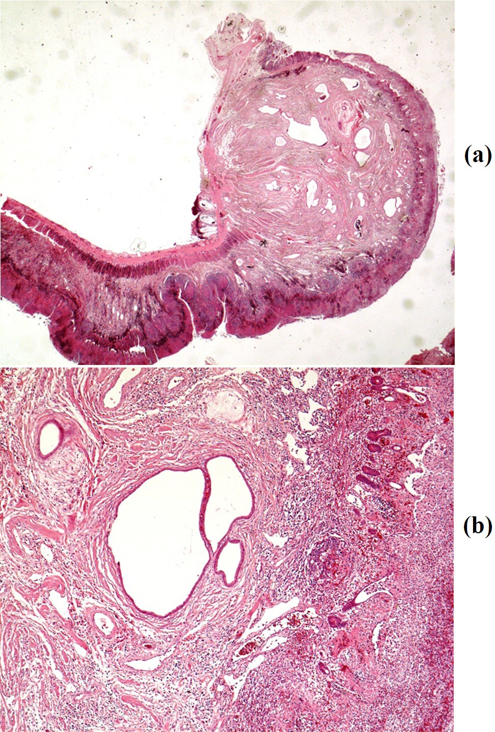 Adenomyoma of the small intestine a rare pathological lead point for ...