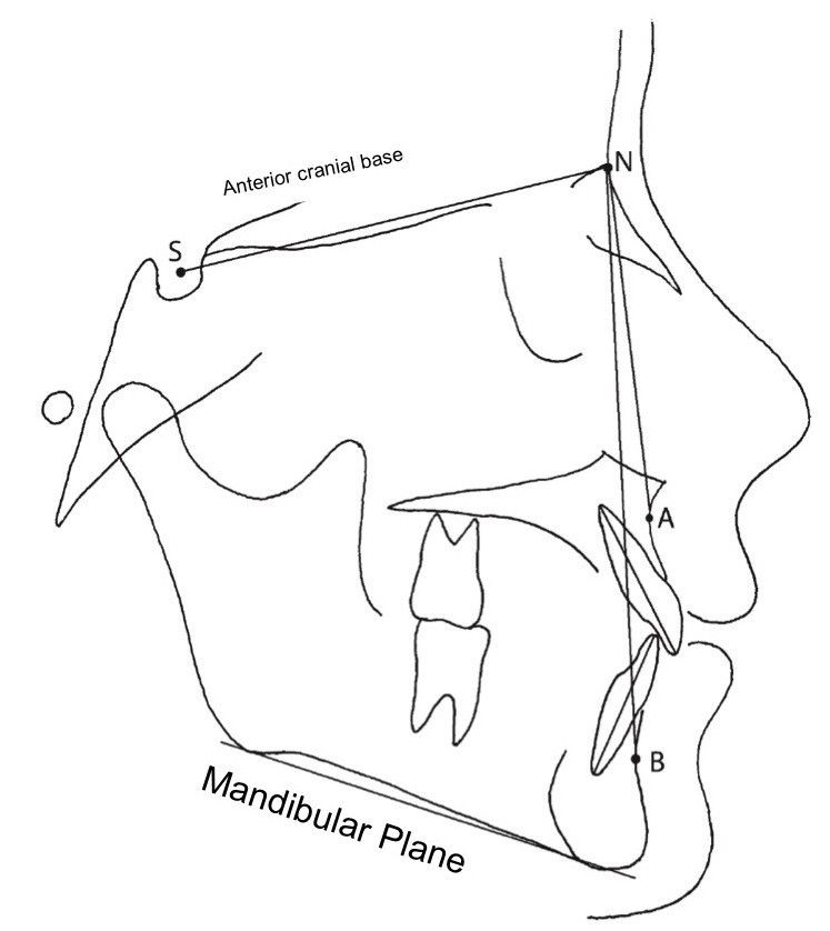 Relationship Between Vertical Facial Patterns And Dental Arch Form In