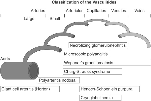 Vasculitis: mechanisms involved and clinical manifestations | Arthritis ...