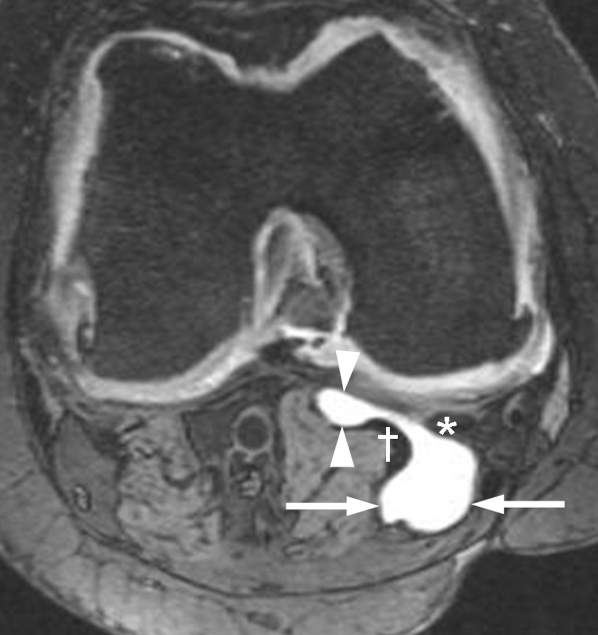 Longitudinal assessment of cyst-like lesions of the knee and their ...