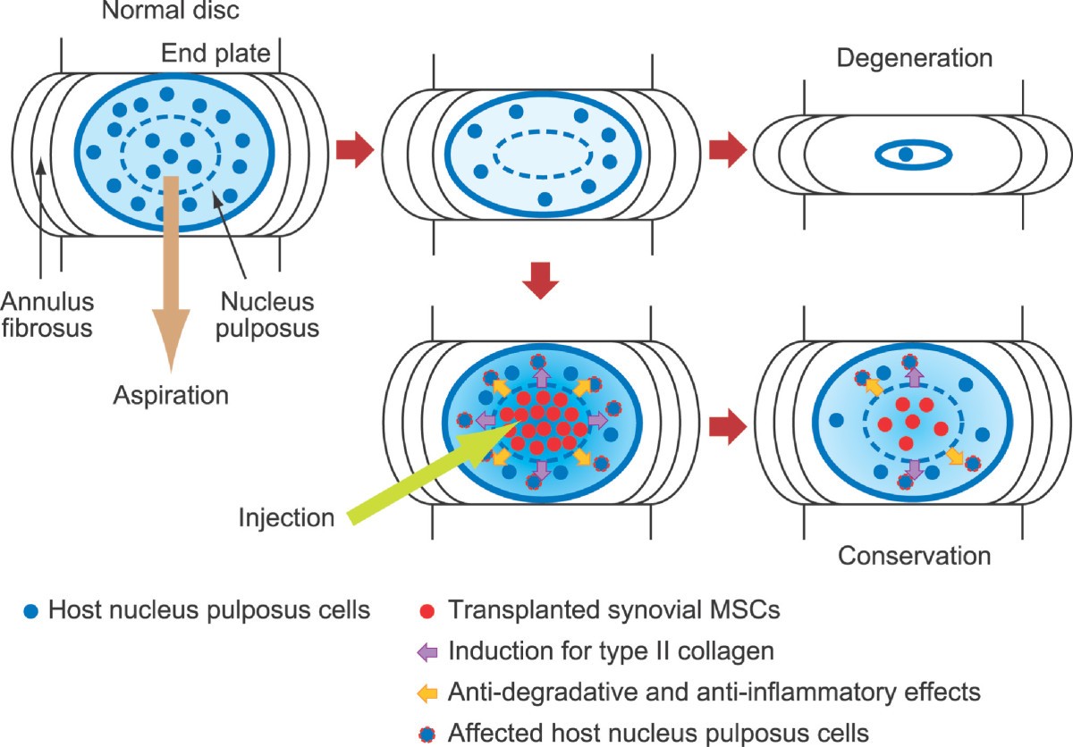 Intradiscal transplantation of synovial mesenchymal stem cells prevents intervertebral disc ...