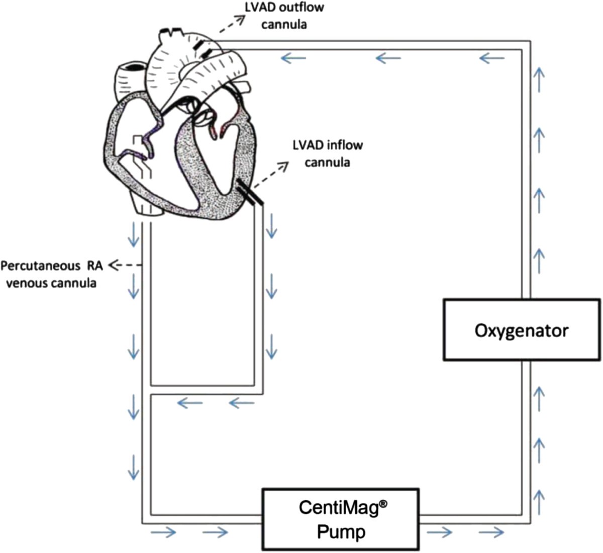 Extracorporeal life support devices and strategies for management of ...