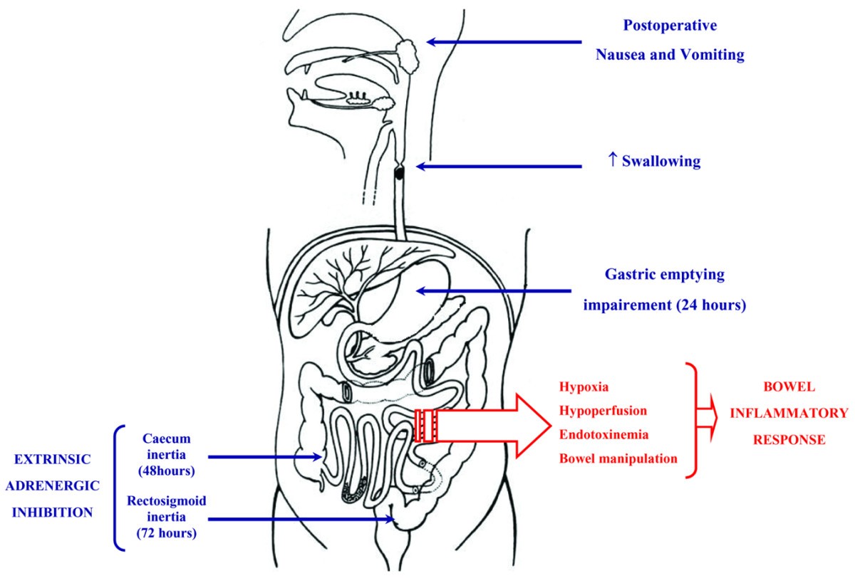 Bench-to-bedside review: Routine postoperative use of the nasogastric ...