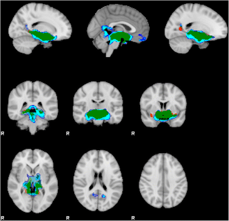 Altered functional resting-state hypothalamic connectivity and abnormal ...