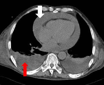 Intrapericardial fibrinolysis in purulent pericarditis—case report ...
