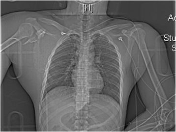 “Floating shoulder” injuries | International Journal of Emergency ...