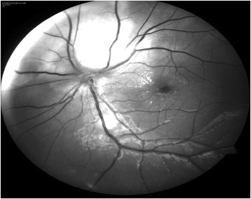 Bilateral choroidal tuberculoma in miliary tuberculosis - report of a ...