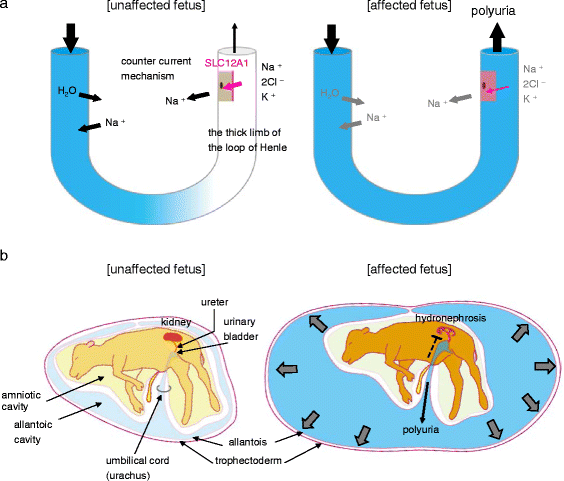A missense mutation in solute carrier family 12, member 1 (SLC12A1 ...