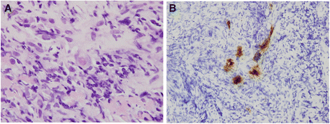 Cytomegalovirus colitis in hospitalized inflammatory bowel disease ...