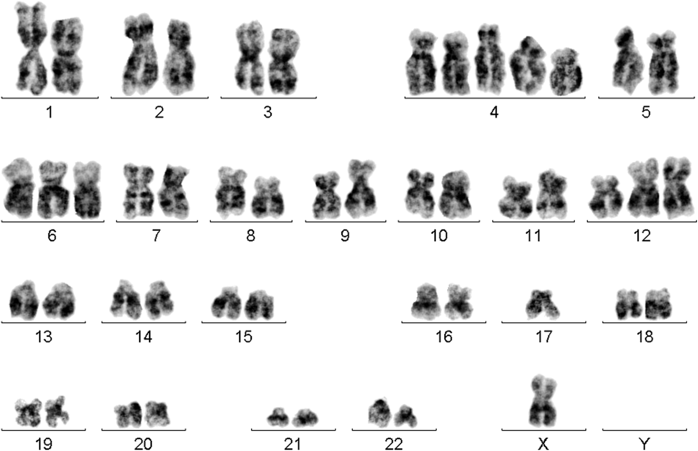 A new adult AML case with an extremely complex karyotype, remission and ...