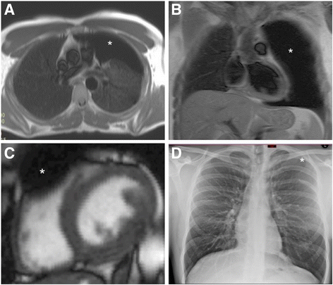 Incidental finding of large pneumothorax on Cardiac MR scan | BMC ...