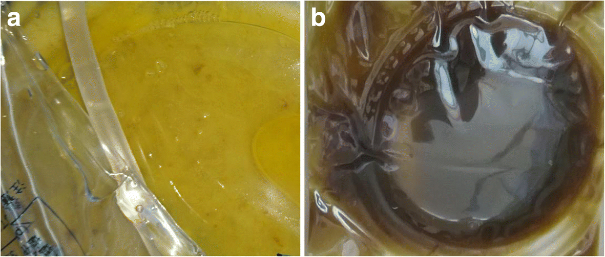 Adhesive intestinal obstruction increases the risk of intestinal ...