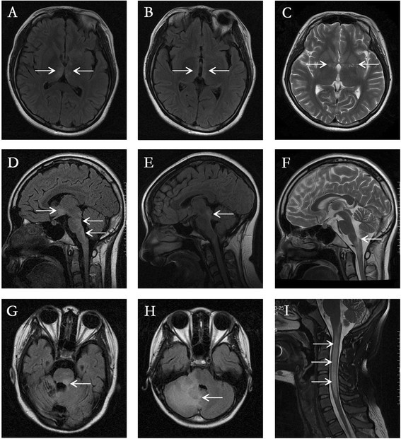 Neuromyelitis optica spectrum disorders without and with autoimmune diseases | BMC Neurology ...