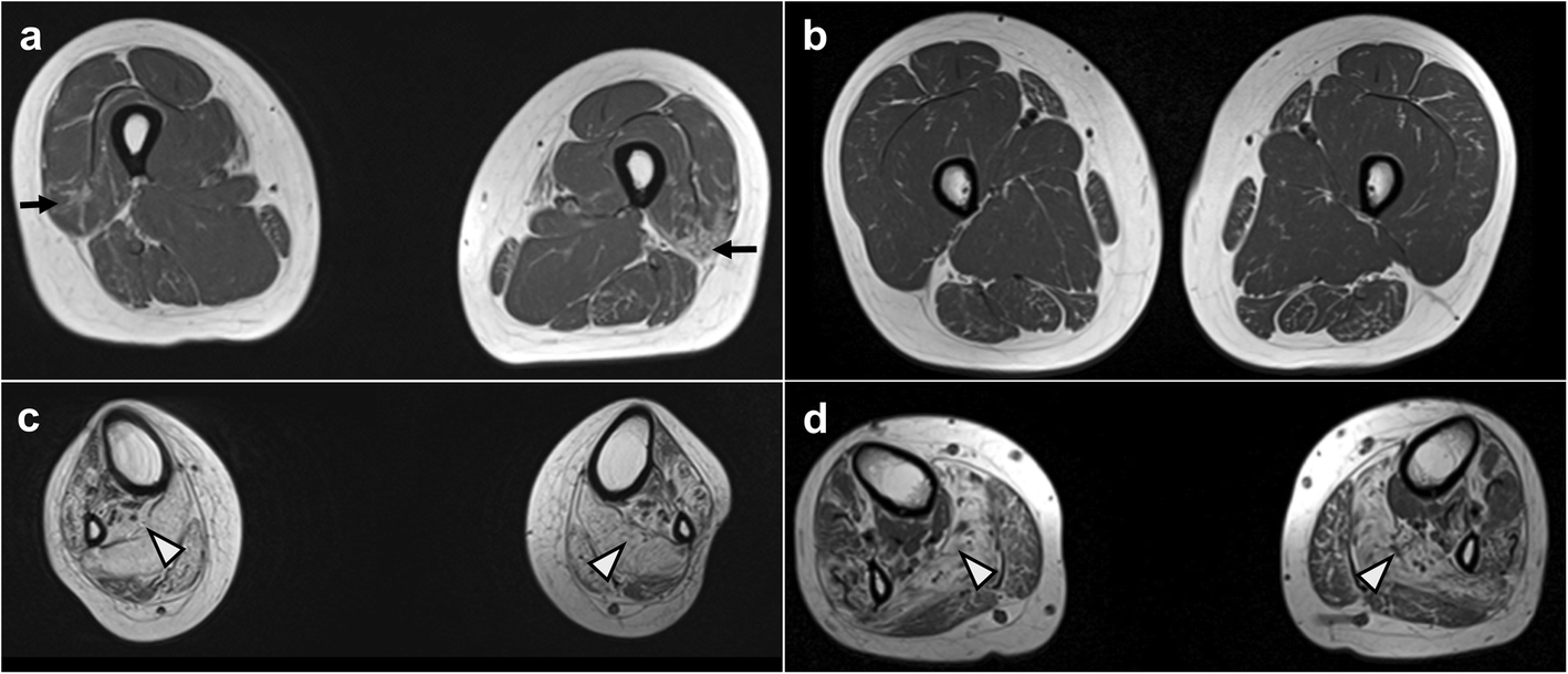 A novel homozygous MPV17 mutation in two families with axonal ...
