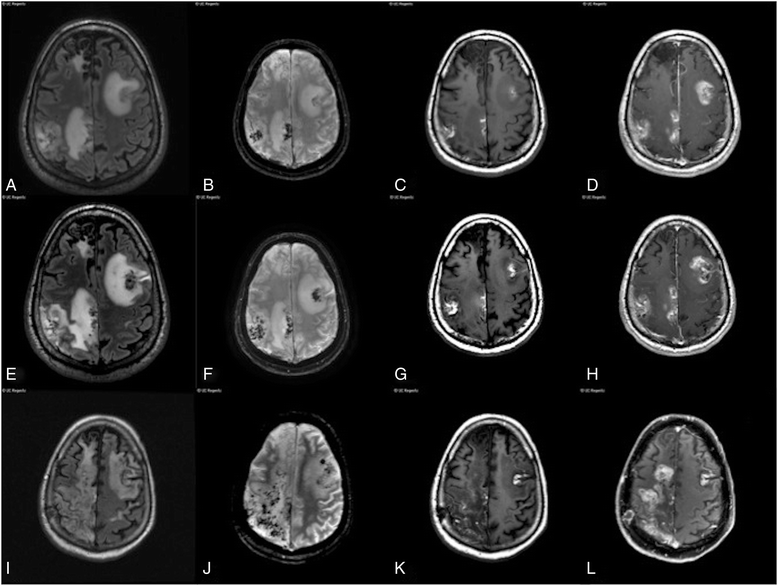 Adult-onset central nervous system hemophagocytic lymphohistiocytosis ...