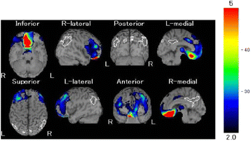 Disappearance of treatment-resistant depression after damage to the ...