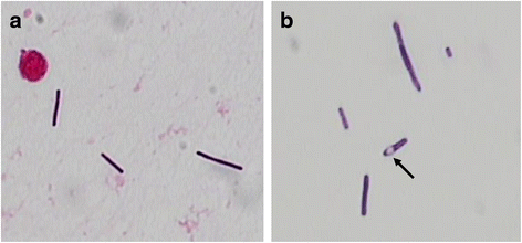 Ischaemic stroke and Clostridium septicum sepsis and meningitis in a ...