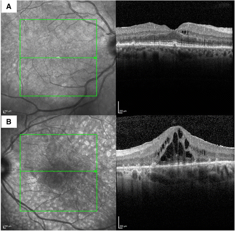 Bilateral Diffuse Uveal Melanocytic Proliferation (BDUMP) associated ...