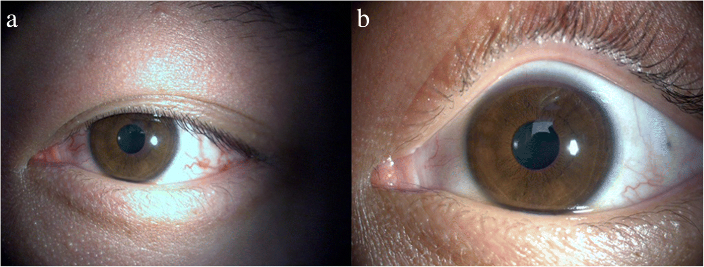 Post-traumatic right carotid-cavernous fistula resulting in symptoms in ...