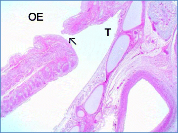 Two case reports of unexpected tracheal agenesis in the neonate: 3 C’s ...