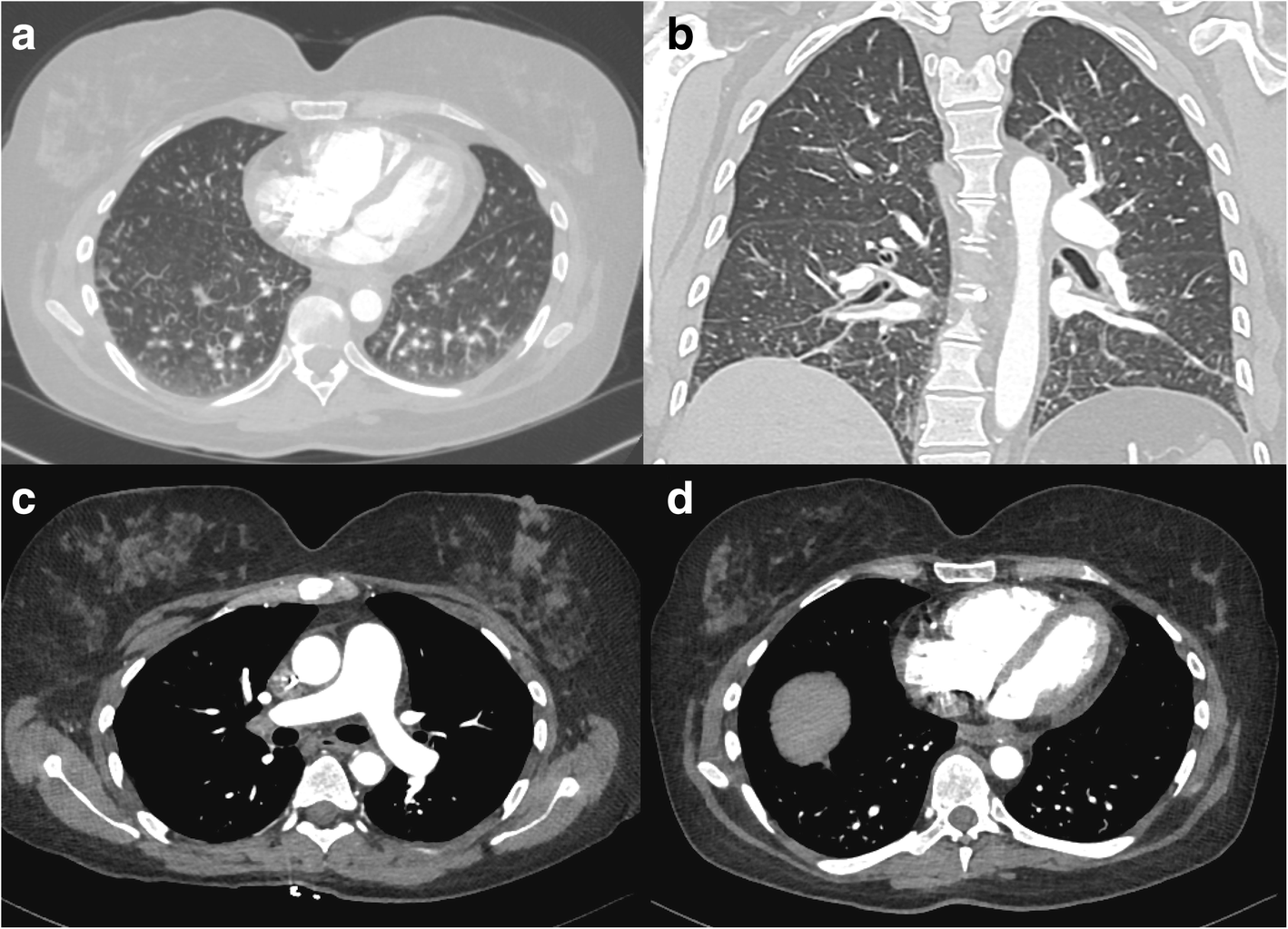 Pulmonary tumor thrombotic microangiopathy and pulmonary veno-occlusive ...
