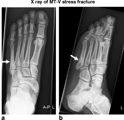 The effect of concentrated bone marrow aspirate in operative treatment ...