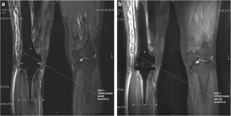 Novel MR imaging method – MAVRIC – for metal artifact suppression after ...