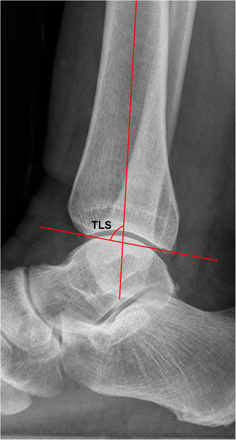 Reliability of measurements on lateral ankle radiographs | BMC ...