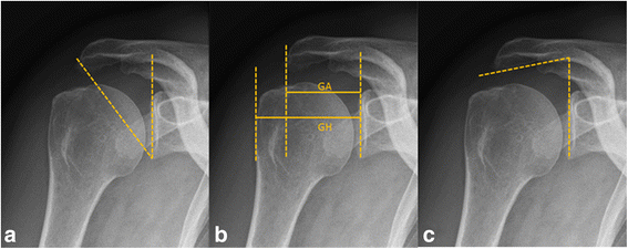 Critical shoulder angle combined with age predict five shoulder ...