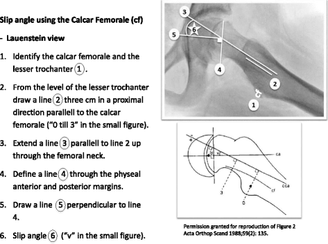 Slipped capital femoral epiphysis: a population-based study | BMC ...