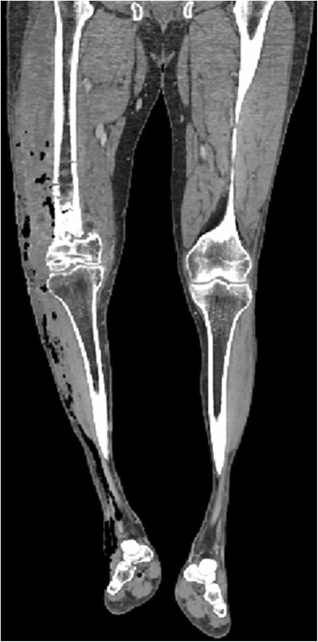 Subcutaneous emphysema of the leg after hardware removal and bone ...