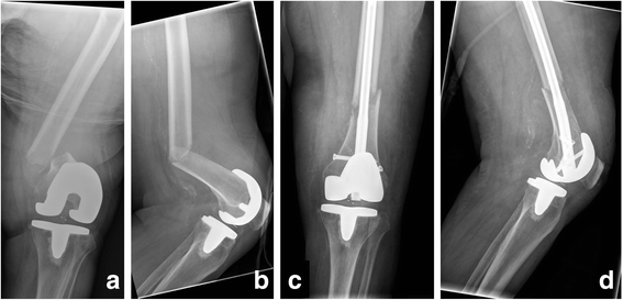 A new classification of TKA periprosthetic femur fractures considering ...