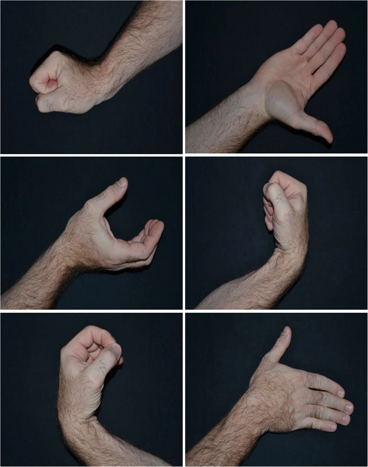 Graded motor imagery for women at risk for developing type I CRPS ...