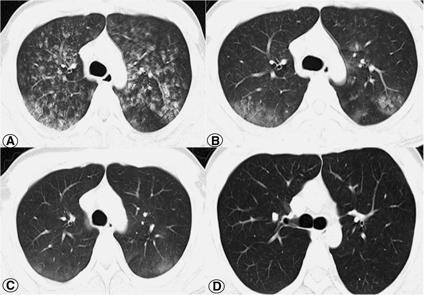 Negative pressure pulmonary edema after percutaneous endoscopic ...