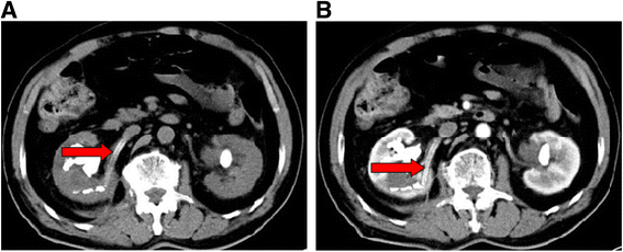 Intravenous misplacement of the nephrostomy catheter following ...