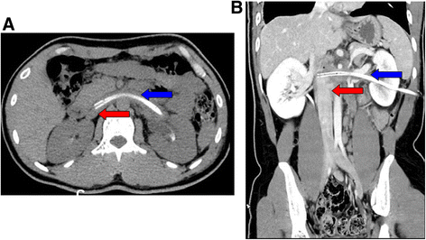 Intravenous misplacement of the nephrostomy catheter following ...