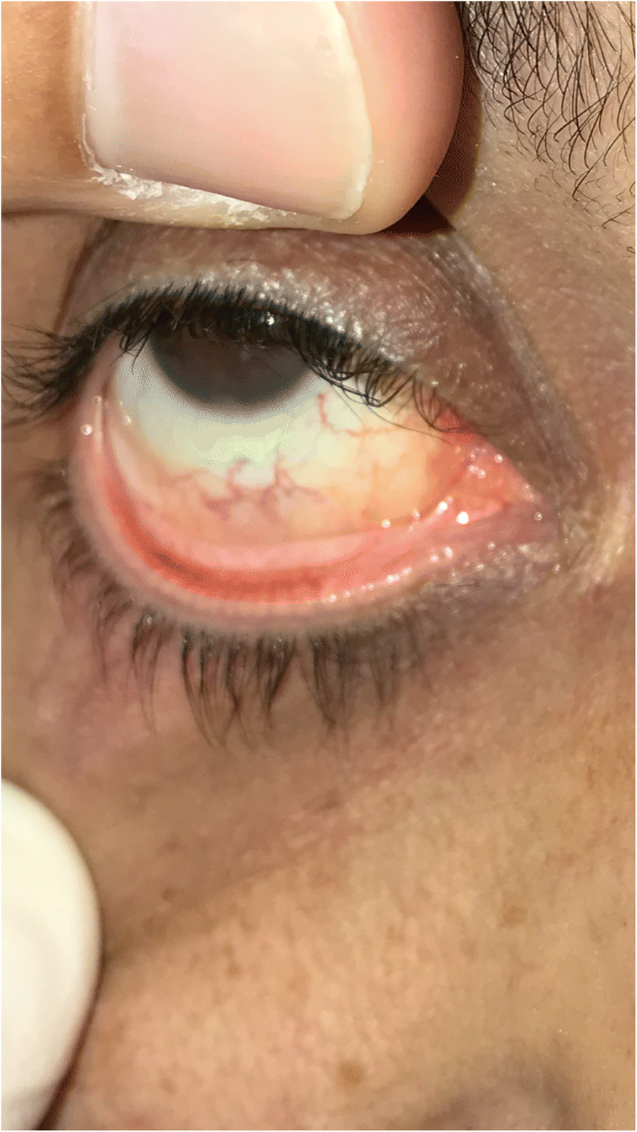 Mucous Membrane Pemphigoid